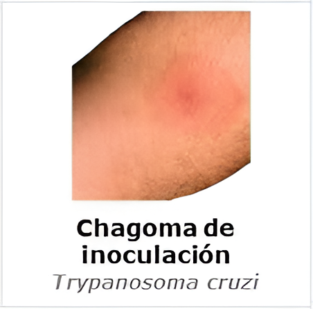 Enfermedad de Chagas | LABORATORIO CHAGAS